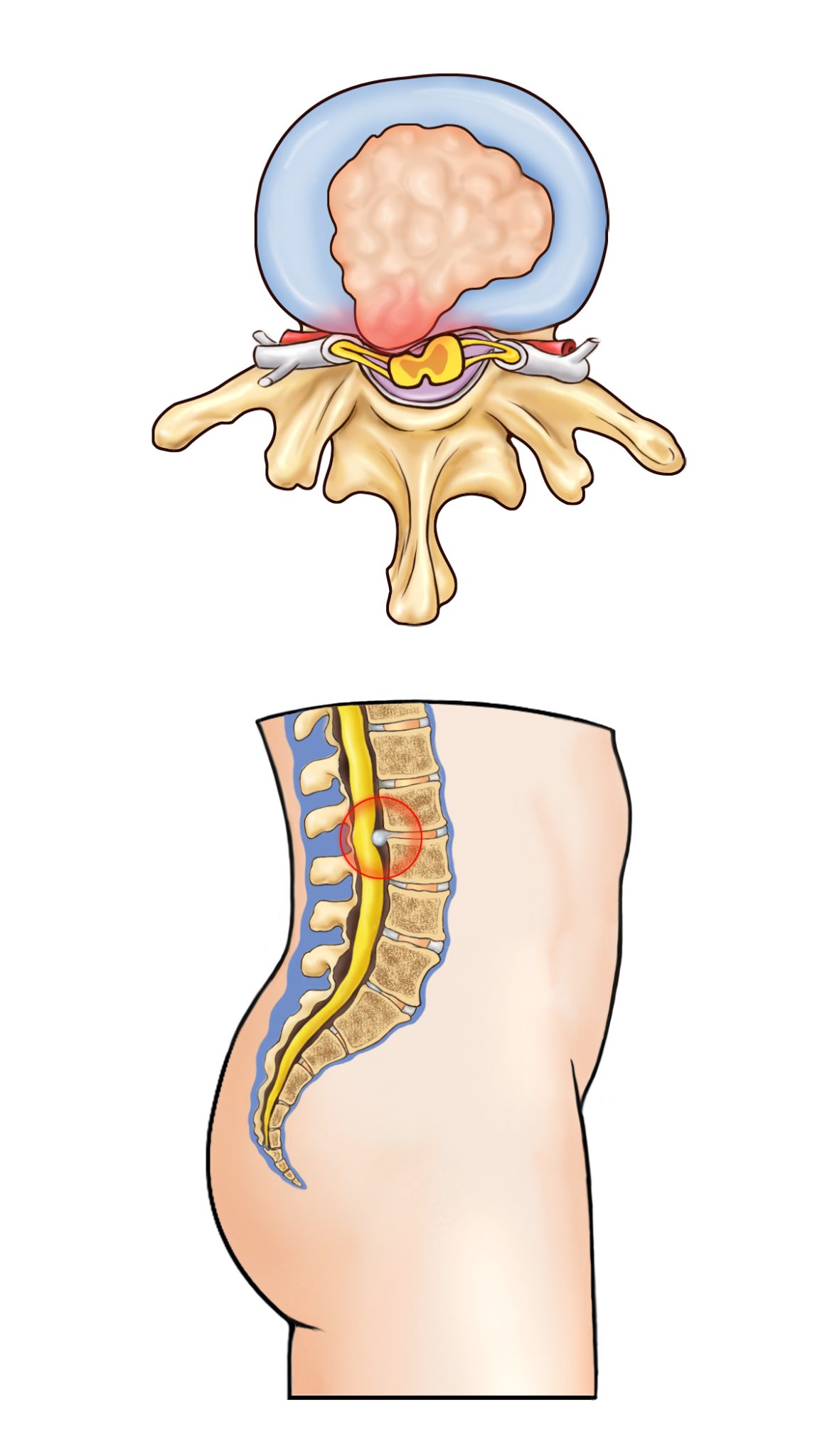 Protruding Disc Relief BeatingBackPain protruding-disc-relief-beatingbackpain